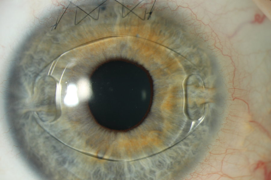 Artisan® Phakic IOLs